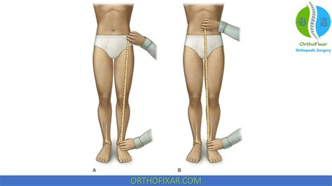 Leg Length Measurement Overview 2025