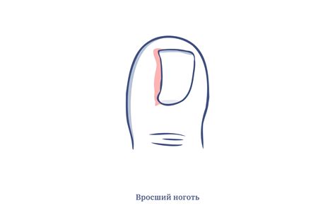 Что делать с вросшим ногтем | Купрум