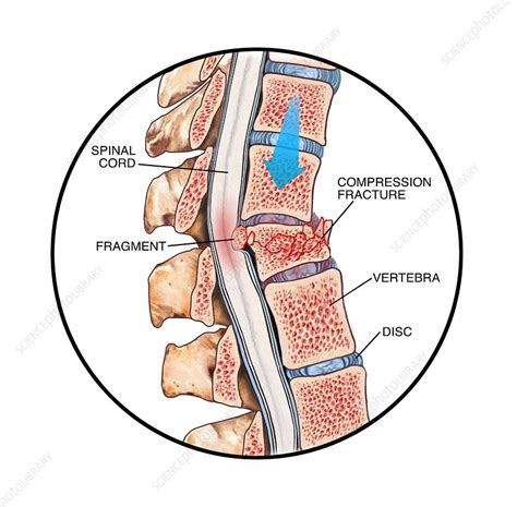 Compression Fracture Diagram Compression Fracture Diagram