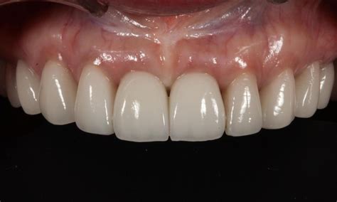 Best Type Of Crown For Anterior Teeth At Jason Pierre Blog