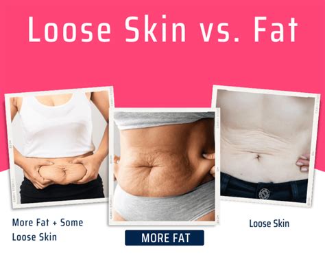 Understanding Loose Skin vs. Fat - Gymperial