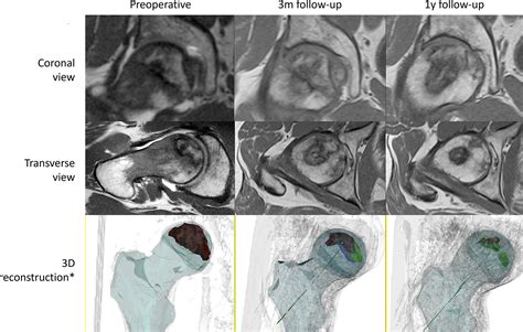 Volume And Location Of Bone Regeneration After Autologous Expanded