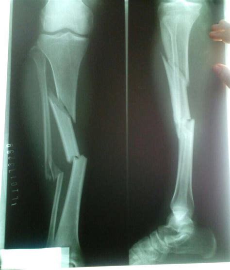Melvin Vásquez Fractura Segmentaría De Tibia Tratada Con