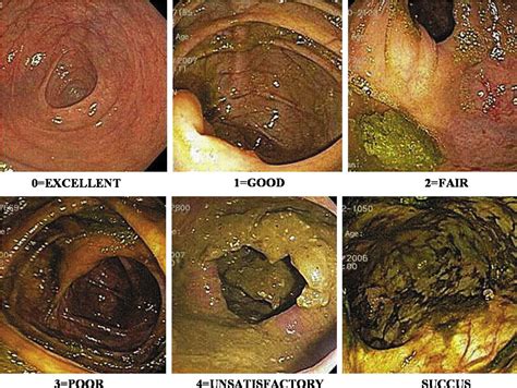 Poor Colonoscopy Prep
