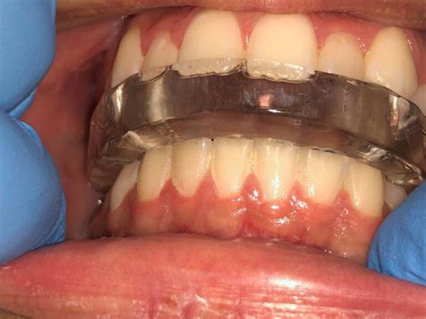 Bite Plates Dr Danka Dentistry
