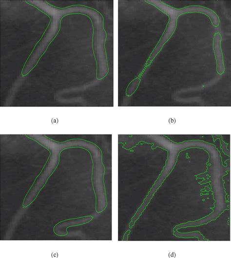 Segmentation Results A Improved Active Contour Method B Local