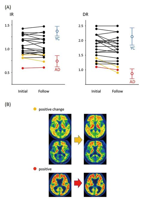 Relationship Between Intentional Flow And β Amyloid Accumulation A Download Scientific