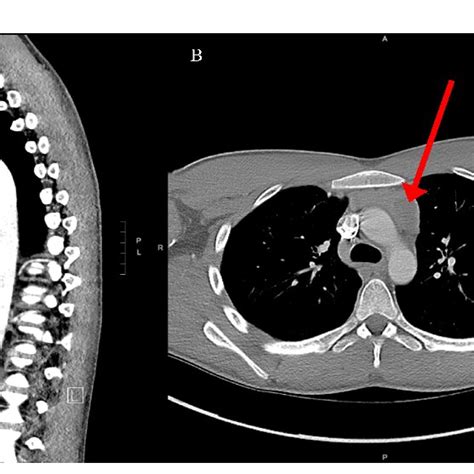 A Nodular Area With Central Low Density In The Left Side Of The Download Scientific Diagram