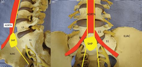 Superior Hypogastric Plexus Block Anesthesia Key