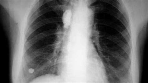 27 повече болни от туберкулоза в Сливенско отчете местната болница Новини бг