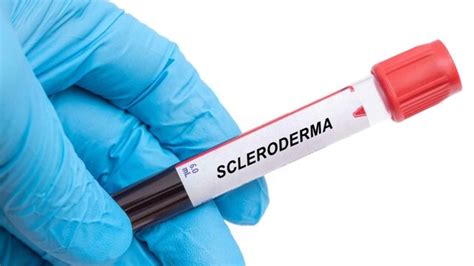 Understanding Scleroderma The Autoimmune Disorder Tightening Skin And Affecting Organs News18