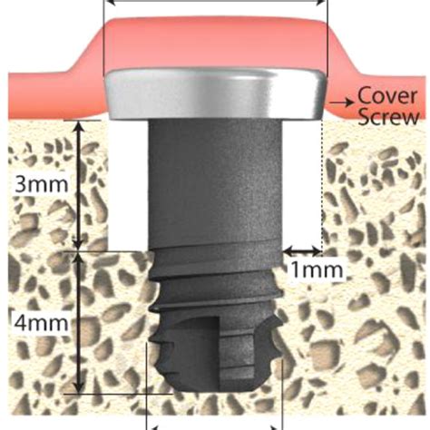 Experimental Implants Design And Schematic Diagram Of The Defect Model Download Scientific