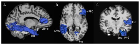 Regions Showing Significant Between Group Differences Mdd