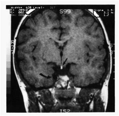 Figure 1 From Association Of Ectopic Posterior Pituitary And Anterior