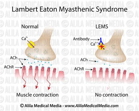 Alila Medical Media Lambert Eaton Myasthenic Syndrome Medical