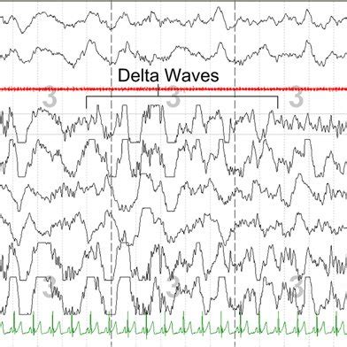 Hallmark Of Stage N3 Slow Wave Sleep Or Stages 3 And 4 Sleep Delta