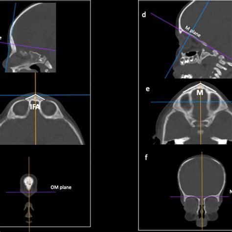 Skull Shape Severity Quantification Using Traditional Cephalic Index