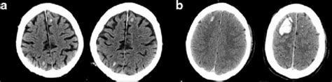 Pecarn Pediatric Head Injurytrauma Algorithm Pediatrics Community
