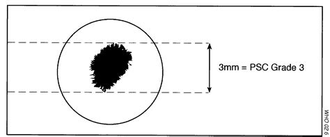 How To Diagnose And Grade Cataracts Eyeguru