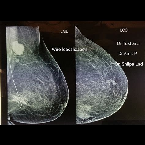 Reduction Mammoplasty With Excision By Stereotactic Localization Olive Cancer Care