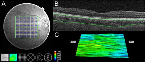 Ss Oct Measurement Ss Oct Image Showing The Measurements Of Choroidal Download Scientific