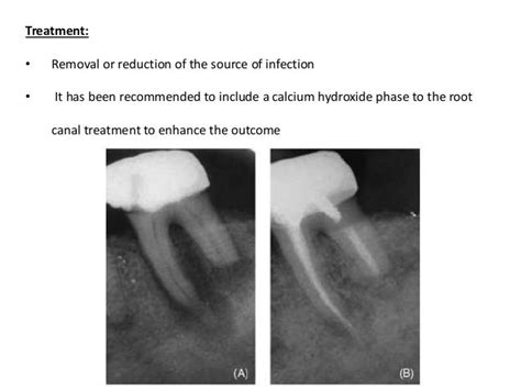 Root Resorption