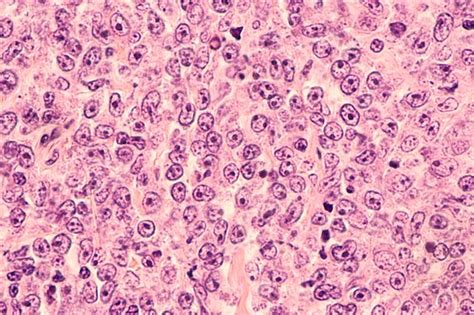 Diffuse Large B Cell Lymphoma An Increasingly Common Disorder