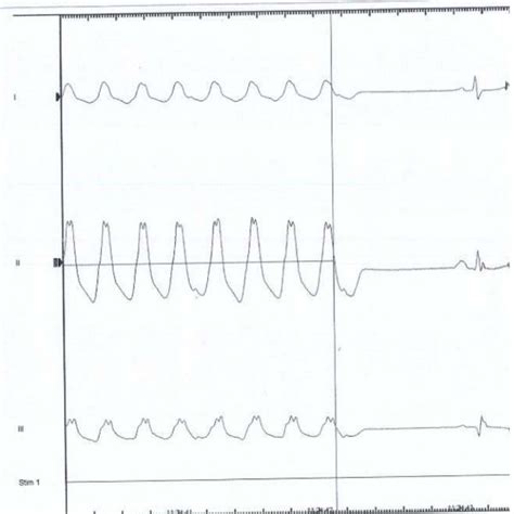 Ventricular Tachycardia Induced During Electrophysiological Study Download Scientific Diagram