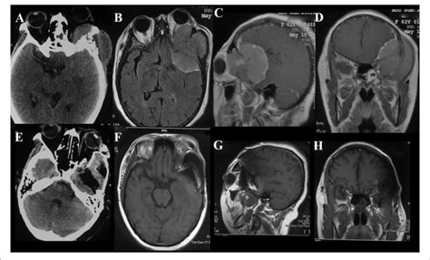 Case Illustrating The Frontotemporal Approach A Ct Scan Show Bone Download Scientific