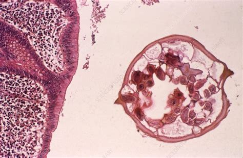 Pinworm Infection Of The Appendix Stock Image C0227218 Science Photo Library