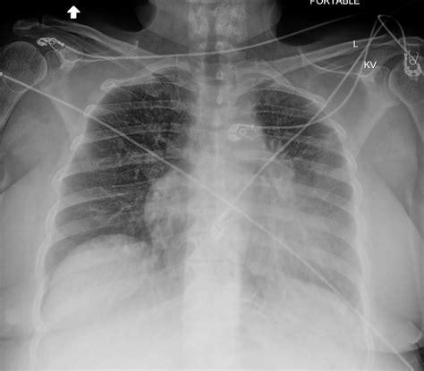 Faces Of Atelectasis Shape The Common Vein