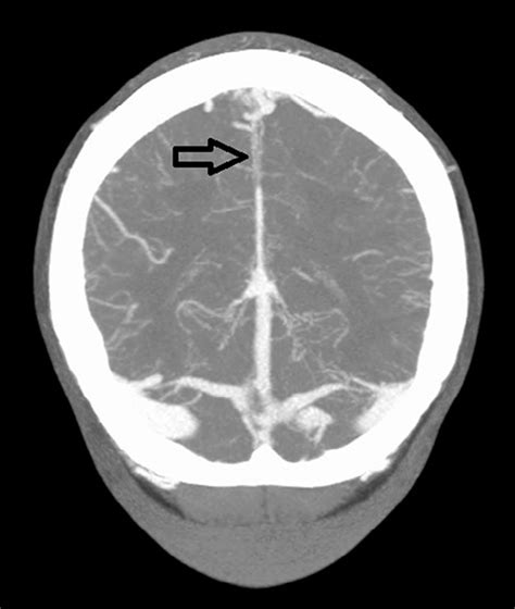 Superior Sagittal Sinus Thrombosis On Computed Tomography Angiogram