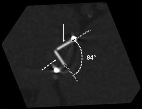 Ecg Gated Mdct After Aortic And Mitral Valve Surgery Ajr