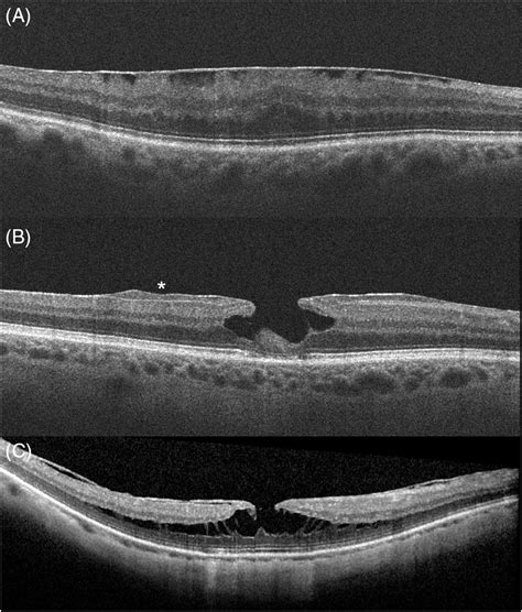 Epiretinal Membrane Oct