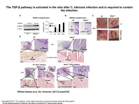 The TGF β pathway is activated in the skin after C ppt download