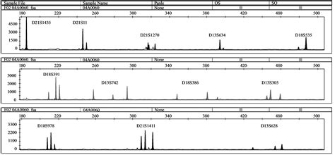 Qf Pcr As A Molecular Based Method For Autosomal Aneuploidies Detection