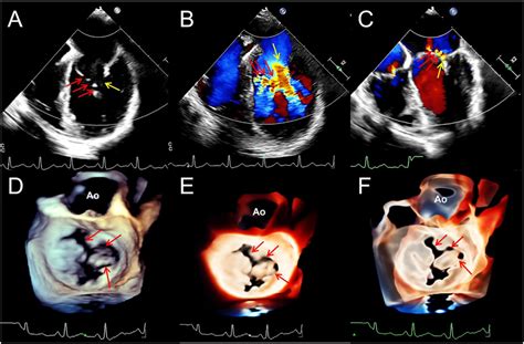 Echo Complete 2d Transthoracic Echocardiographie Transthoracique Pdf