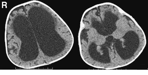 Computed Tomography Scans On Admission Showing Marked Ventricular Download Scientific Diagram