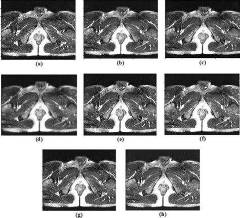 Filtering Of Rician Noise Using Different Filter A Anisotropic Filter Download Scientific