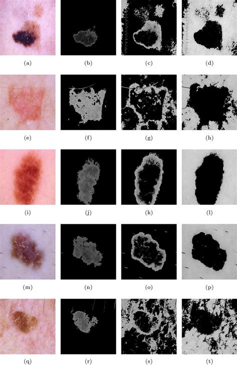 Segmentation Results Of Proposed Algorithm TIFCM For ISIC Download Scientific Diagram