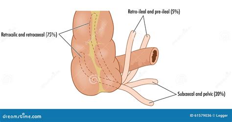 Various Appendix Locations Stock Vector Illustration Of Intestine 61579036 Various Appendix Locations Stock Vector Illustration Of Intestine 61579036