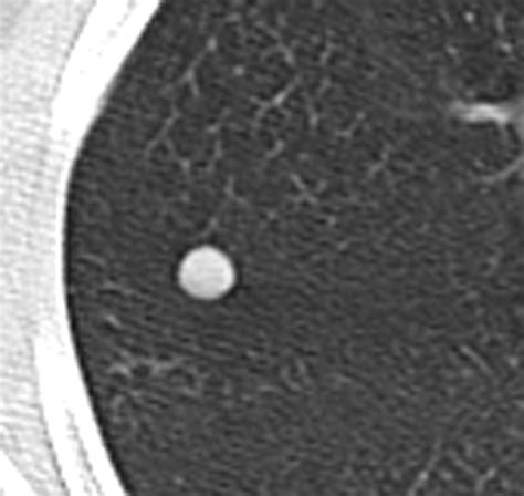 Ct Characteristics Of Lung Nodules Present At Diagnosis Of