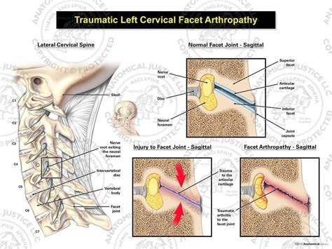 Facet Disease In Spine At Anita Price Blog