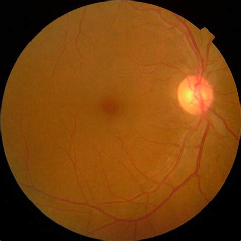 Optic Disc Detection Object Detection Dataset And Pre Trained Model By