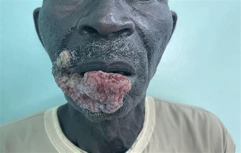 Overview Of Lip Cancers At Fann University Hospital From Epidemiology