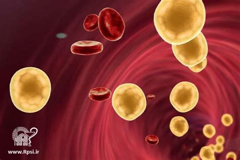 تری گلیسیرید بالا چیست ، علائم ، پیشگیری، درمان