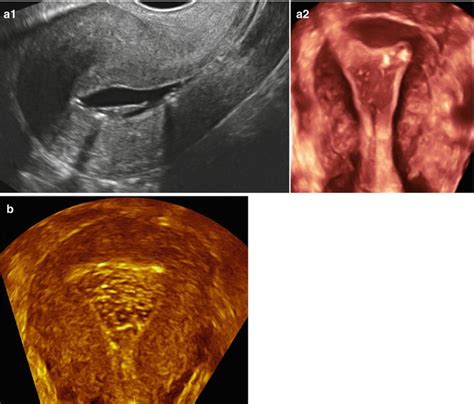 Endometrial Polyps Radiology Key