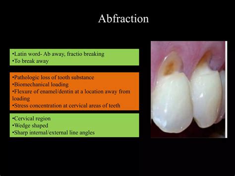 Regressive Alterations Of Teeth Pptx