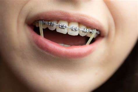 Rubber Bands On Braces Orthodontics Huntington Dr Justyna Balicka