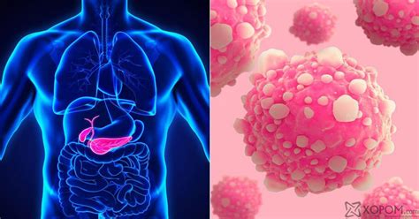 Нойр булчирхайн хорт хавдрын тухай таны заавал мэдэж байх ёстой зүйлс